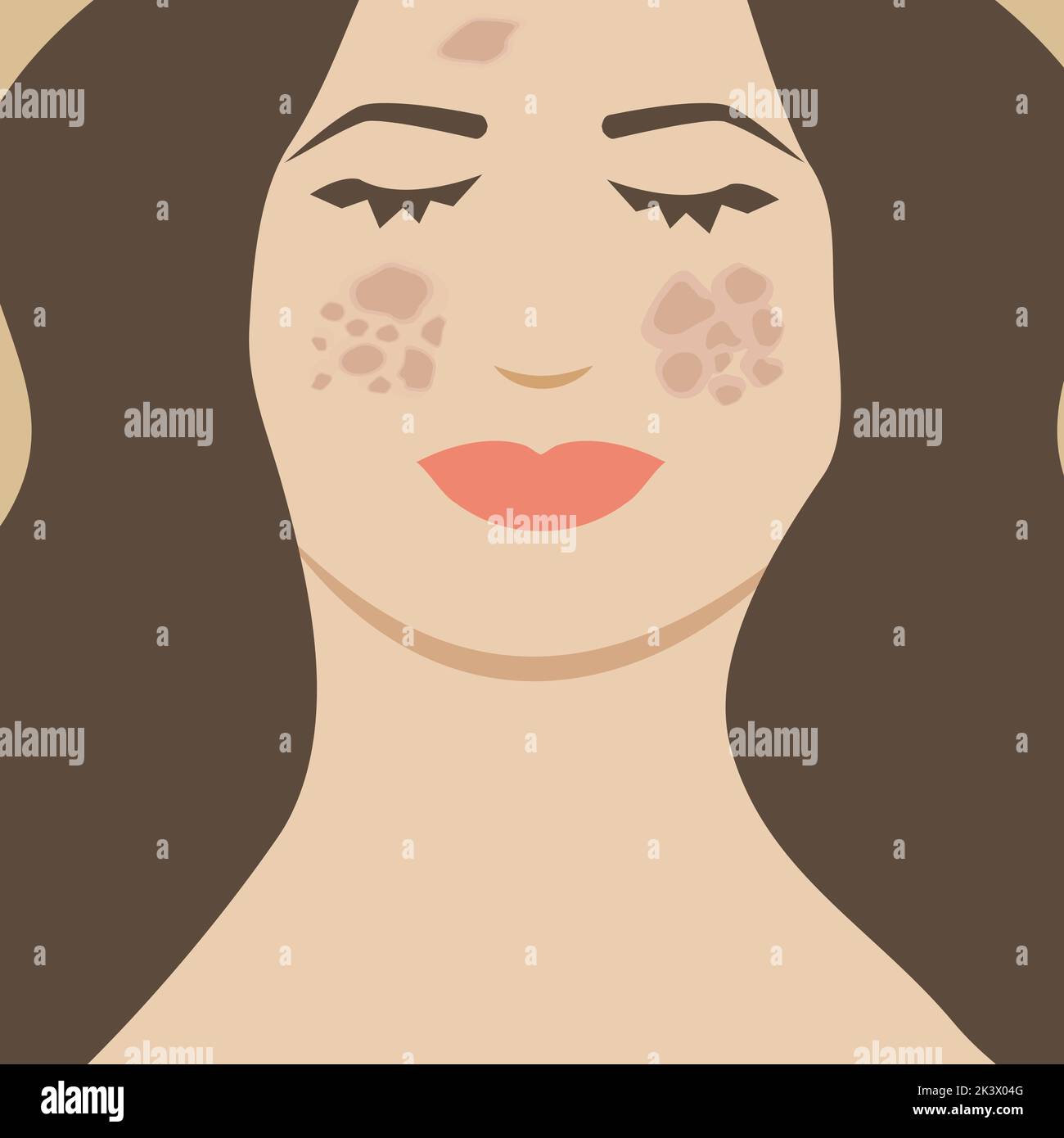 Woman with Melasma on her Face. Illustration of Person with Dark Spots ...