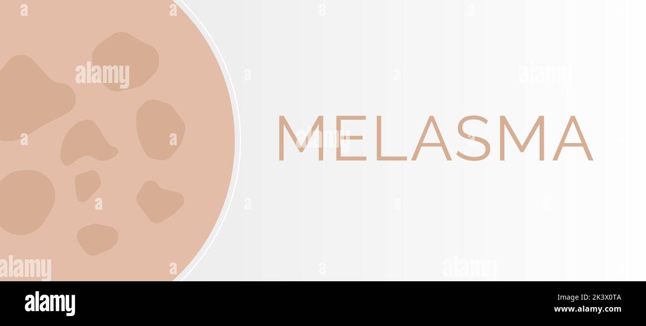 Melasma Skin Condition Illustration Vector Background Stock Vector ...