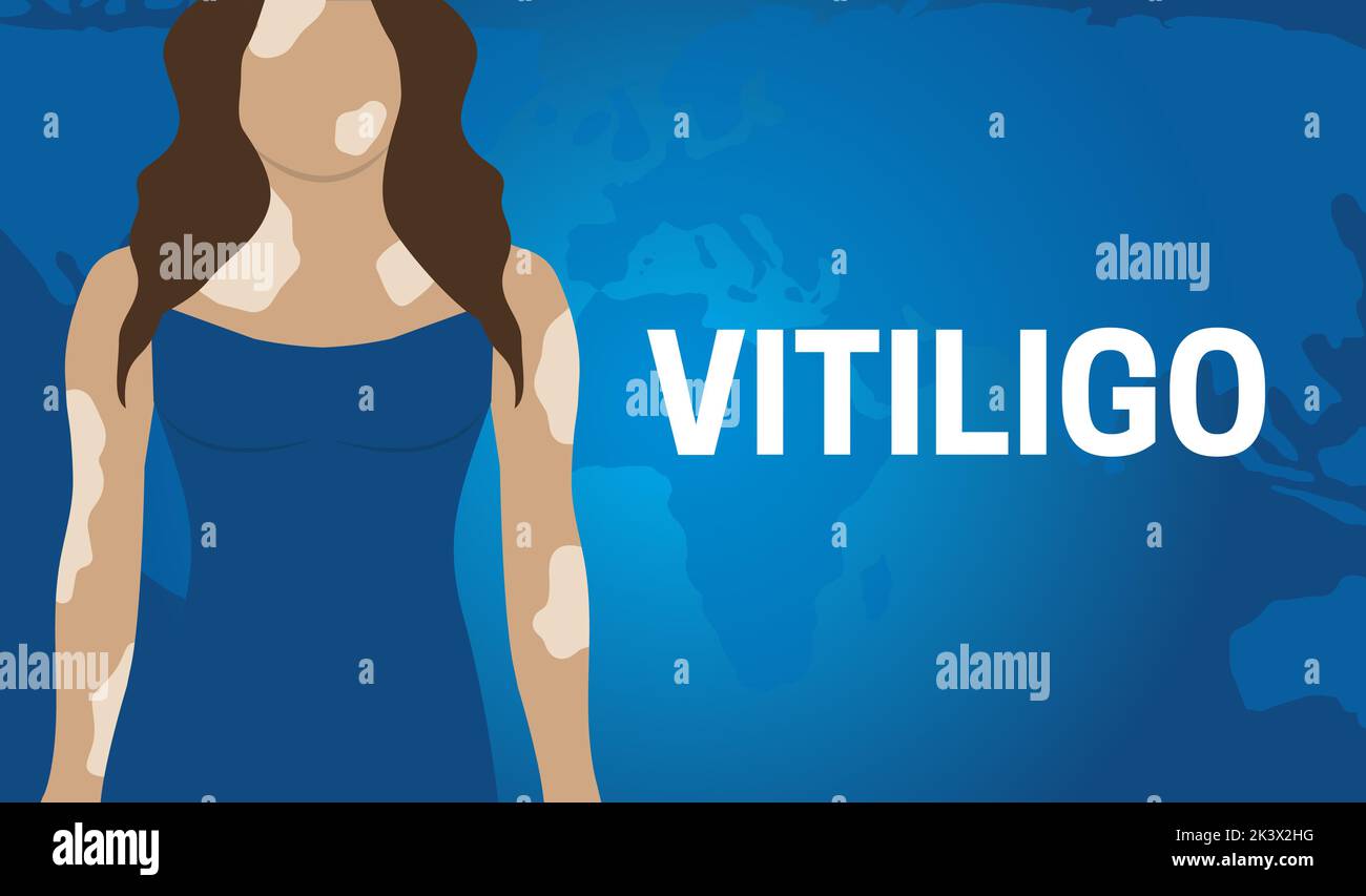 Blue Vitiligo Skin Illness Banner Background Stock Vector Image & Art ...