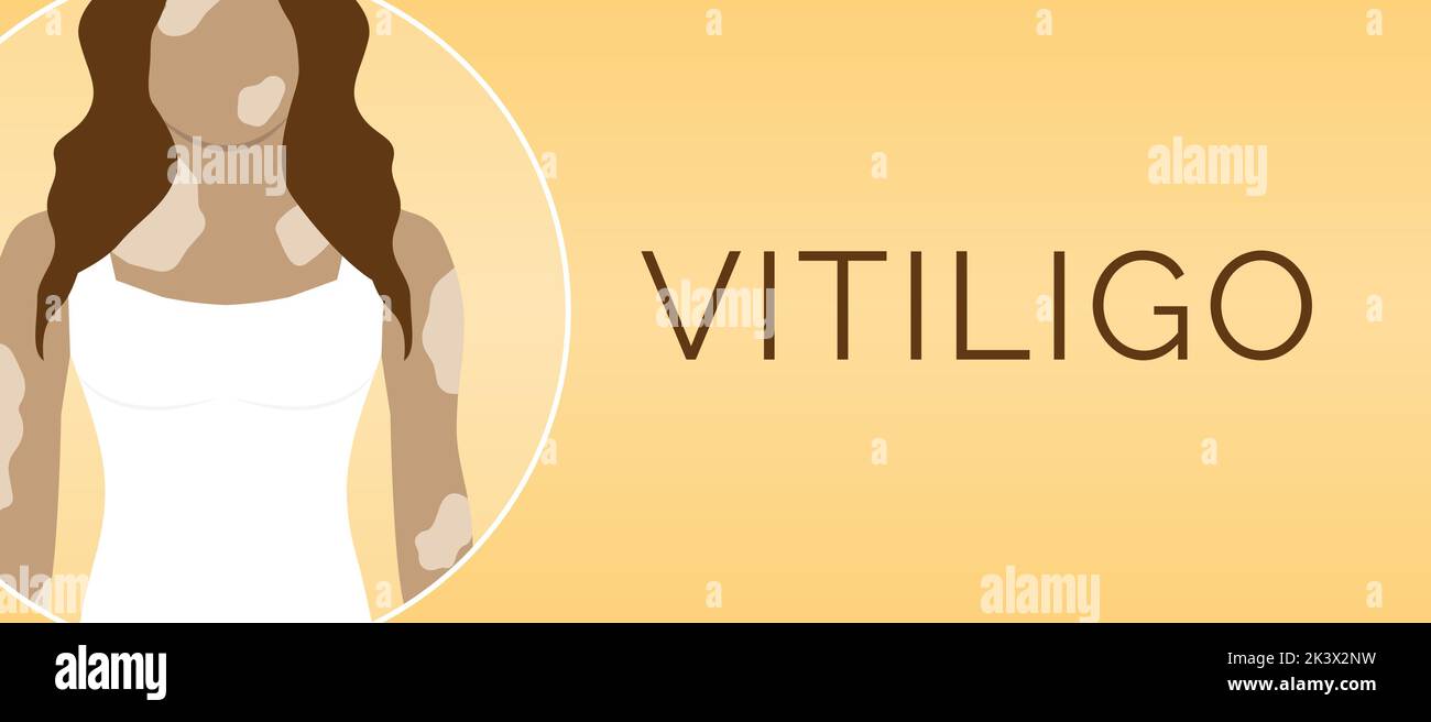 Yellow Vitiligo Skin Illustration Background Stock Vector Image & Art ...