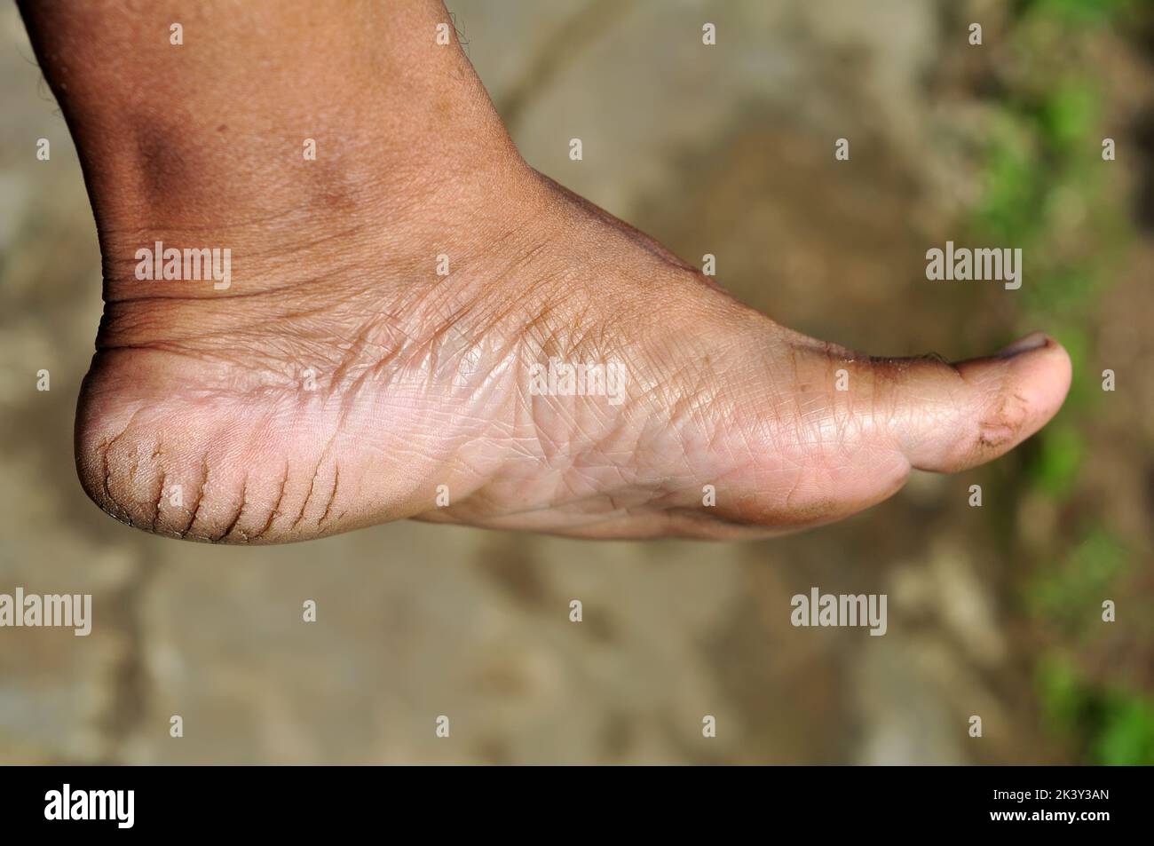 Dry and cracked heels due to lack of moisture in the feet Stock Photo ...