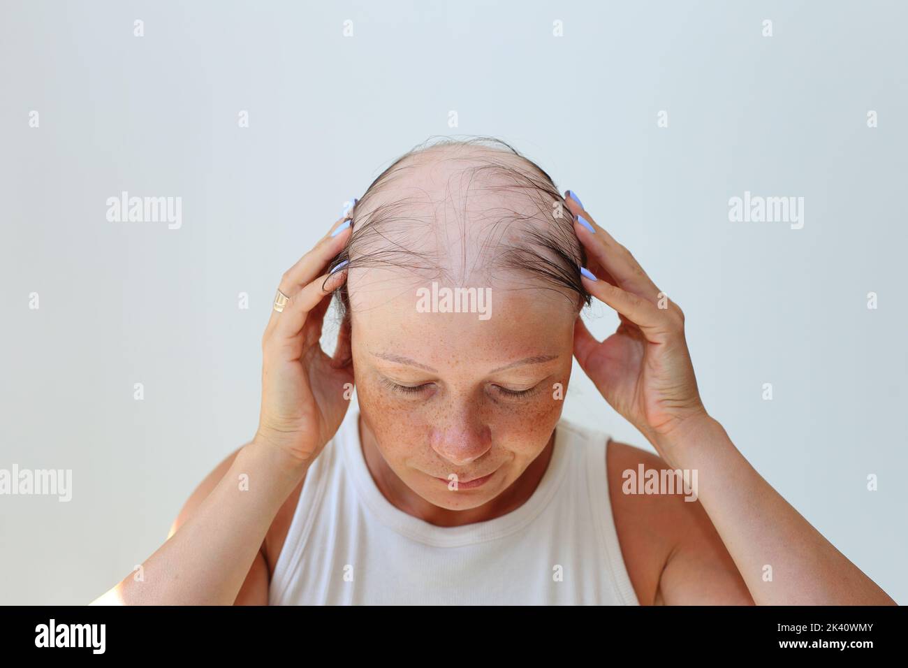 Hair loss in the form of alopecia areata. Bald head of a woman. Hair ...