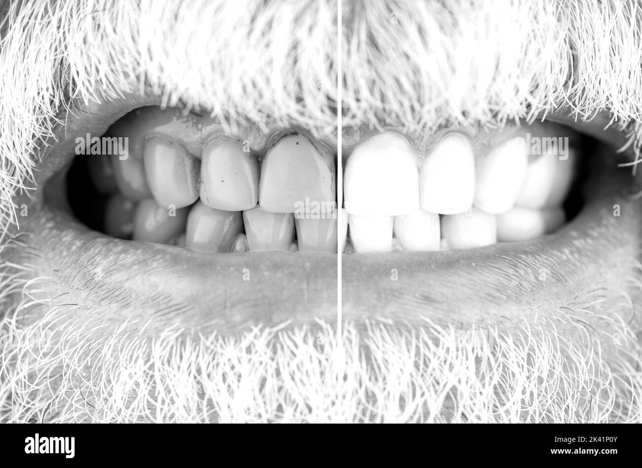 Close-up Of A Smiling man Teeth Before And After Whitening. Male teeth ...