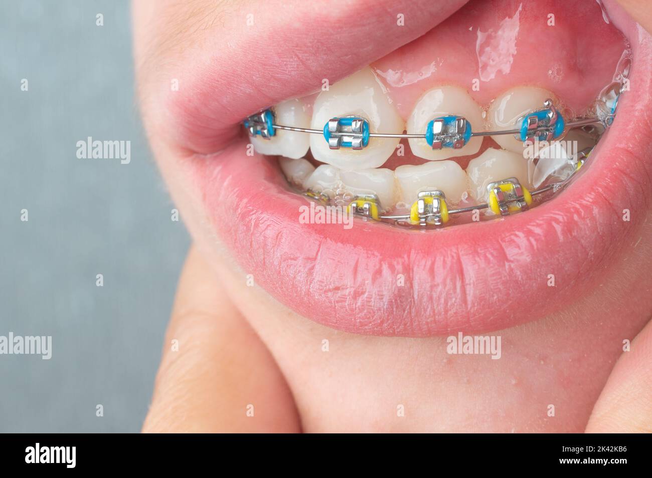 Braces with blue and yellow rubber bands close-up, flag of Ukraine and ...