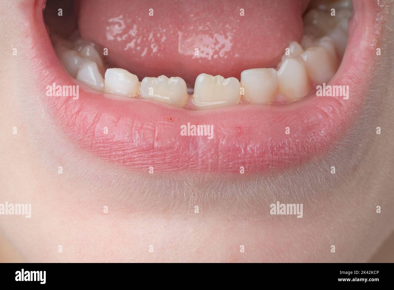 Jaw with child's even teeth close-up, milk and permanent teeth in a ...