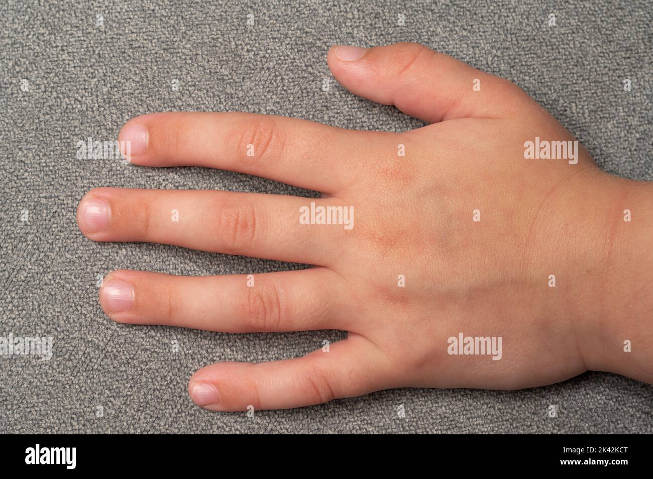 Dirty and sloppily trimmed child's fingernails, fingers and toenails ...