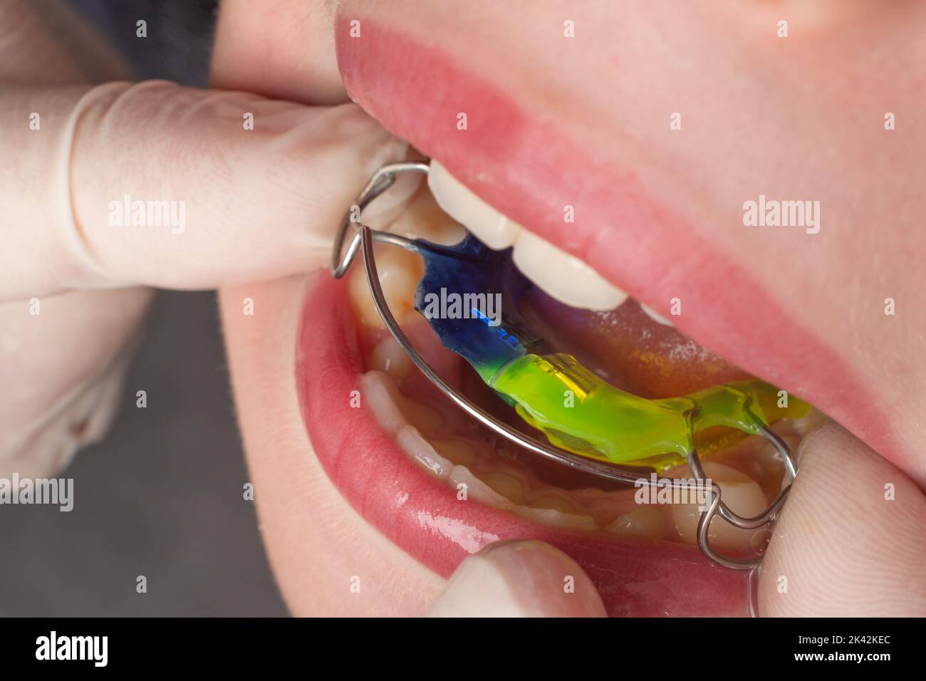 The orthodontist puts a plate on the lower teeth, a visit to the ...