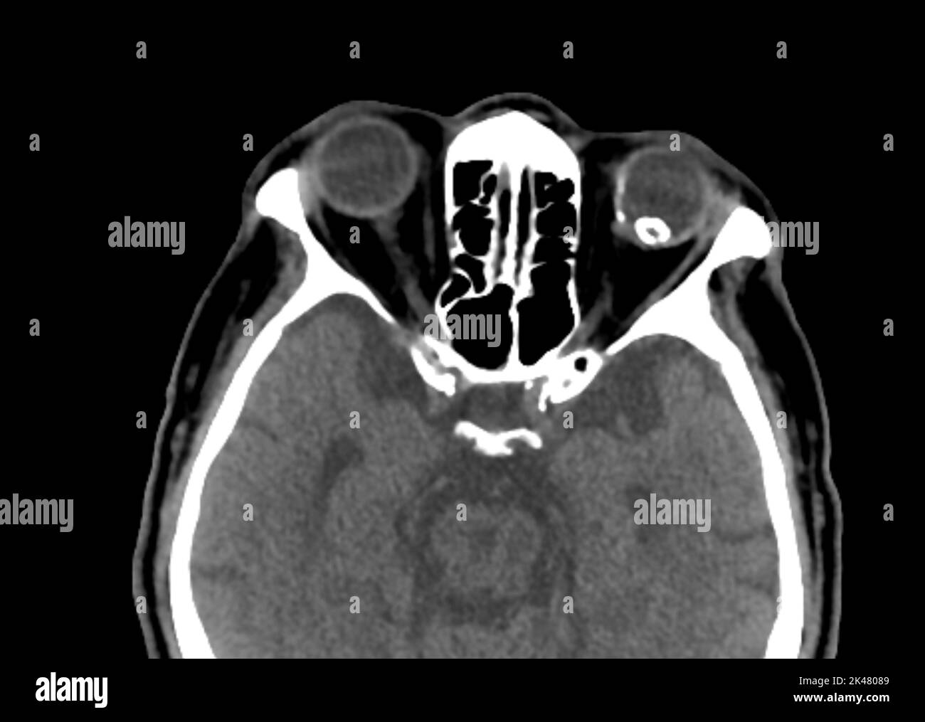 Dislocated lens of the eye, CT scan Stock Photo - Alamy