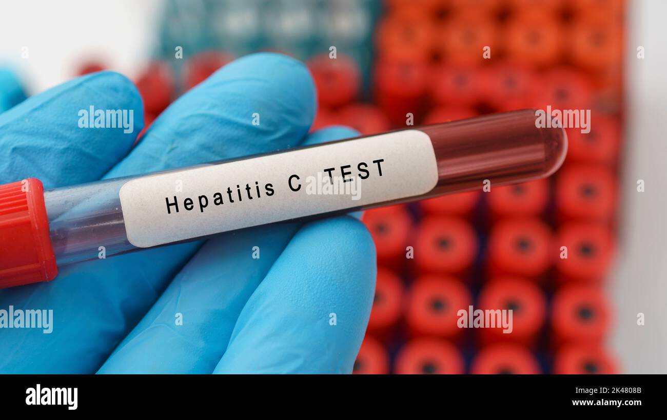 Hepatitis c screening hi-res stock photography and images - Alamy