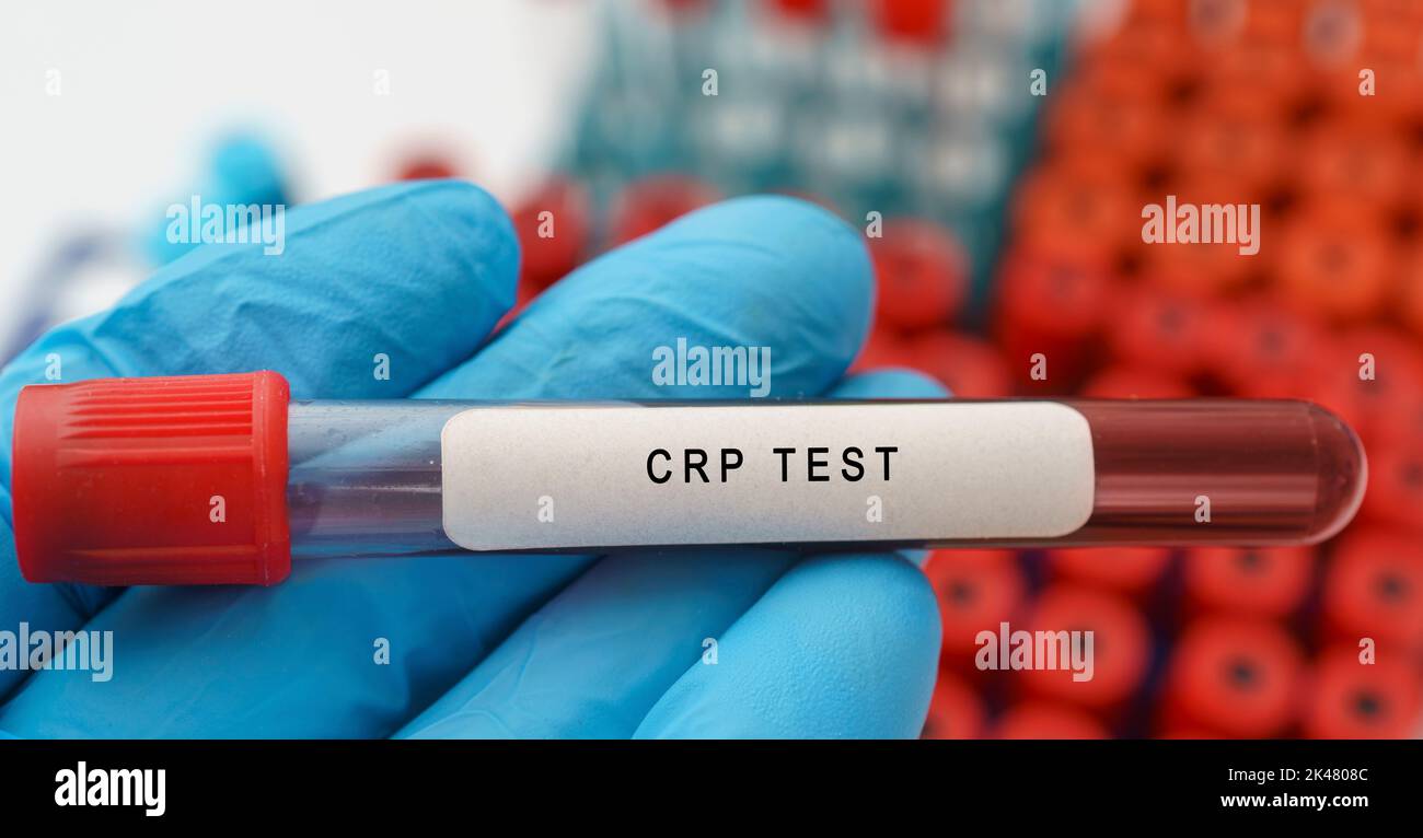 C-reactive protein blood test, conceptual image Stock Photo - Alamy C-reactive protein blood test, conceptual image Stock Photo - Alamy