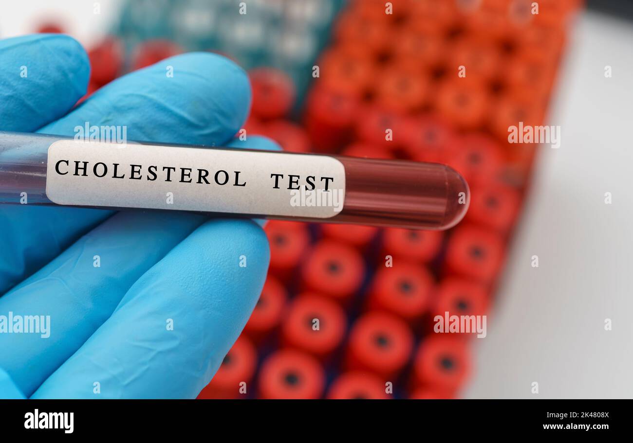 Cholesterol test hi-res stock photography and images - Alamy