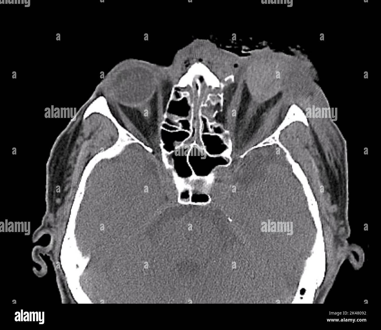 Ruptured globe hi-res stock photography and images - Alamy