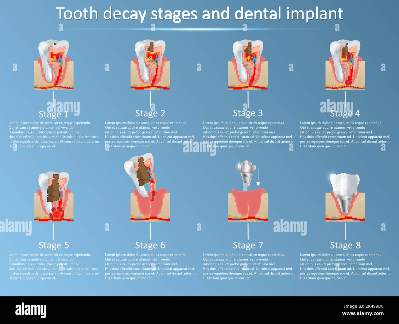 Tooth decay stages and dental implant. Vector illustration. Dental ...