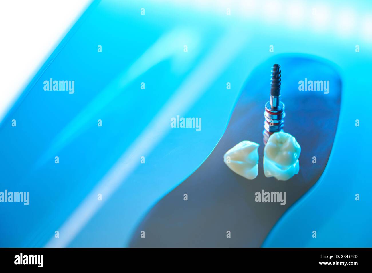 Photo of teeth and dental pin for restoration of tooth Stock Photo - Alamy