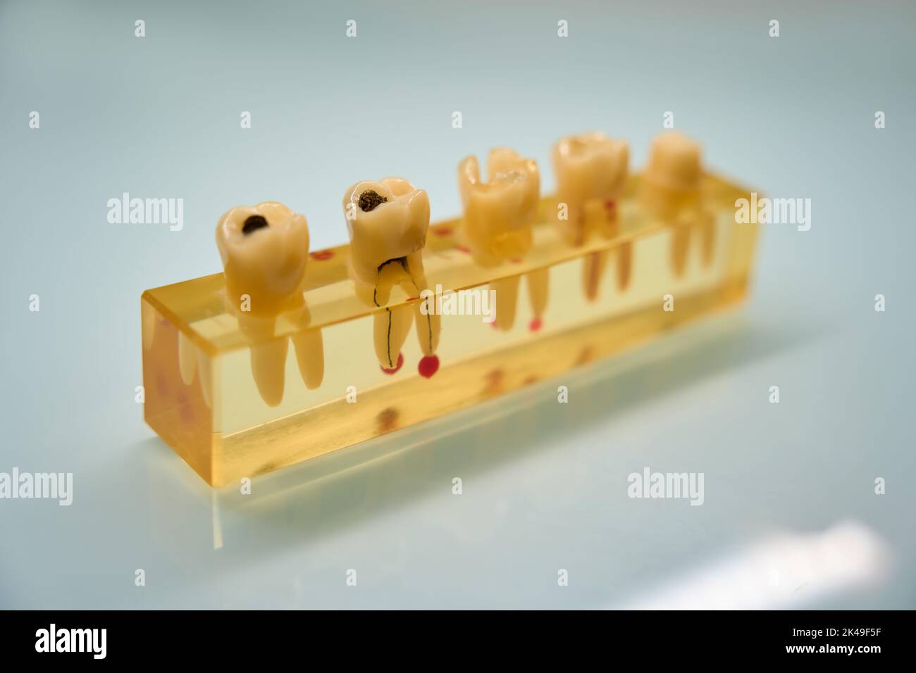 Models of teeth affected by caries on transparent silicone stand Stock ...