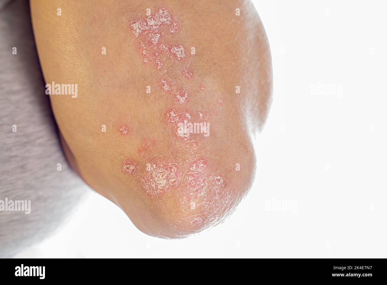 Psoriasis On Elbows Close Up Autoimmune Incurable Dermatological Skin Disease Psoriasis