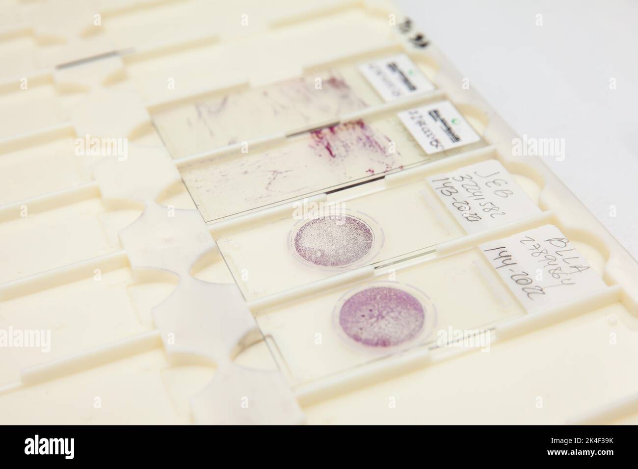 Traditional and liquid based cytology microscope slides for pap smear ...