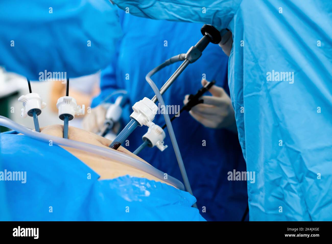 Laparoscopic surgical equipment during proctological minimally invasive ...