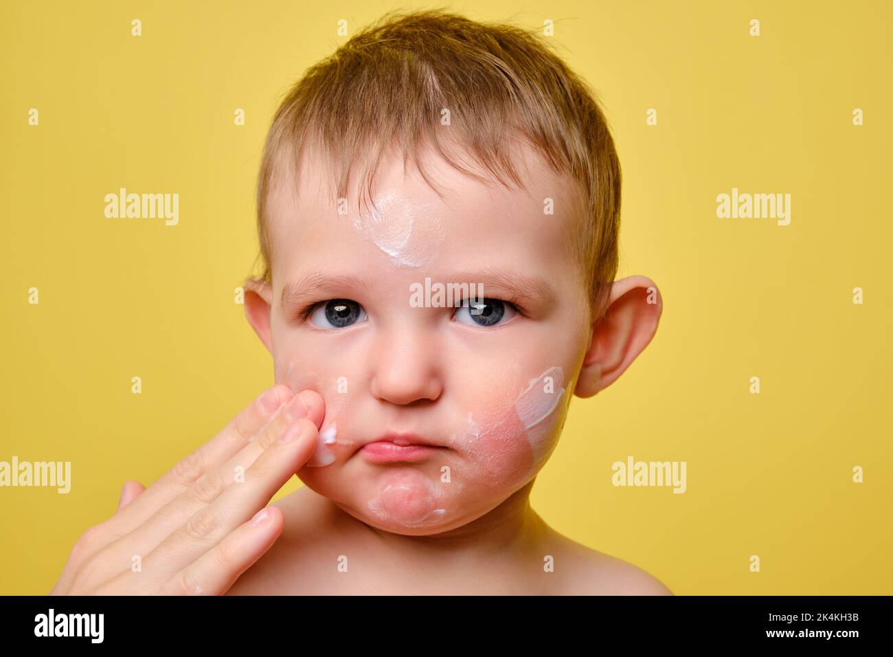 Mother smears allergy cream on face of toddler baby, studio yellow ...