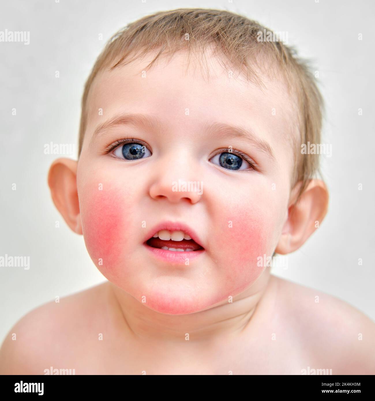 Portrait of a child with allergies on the cheeks and chin. Toddler baby ...