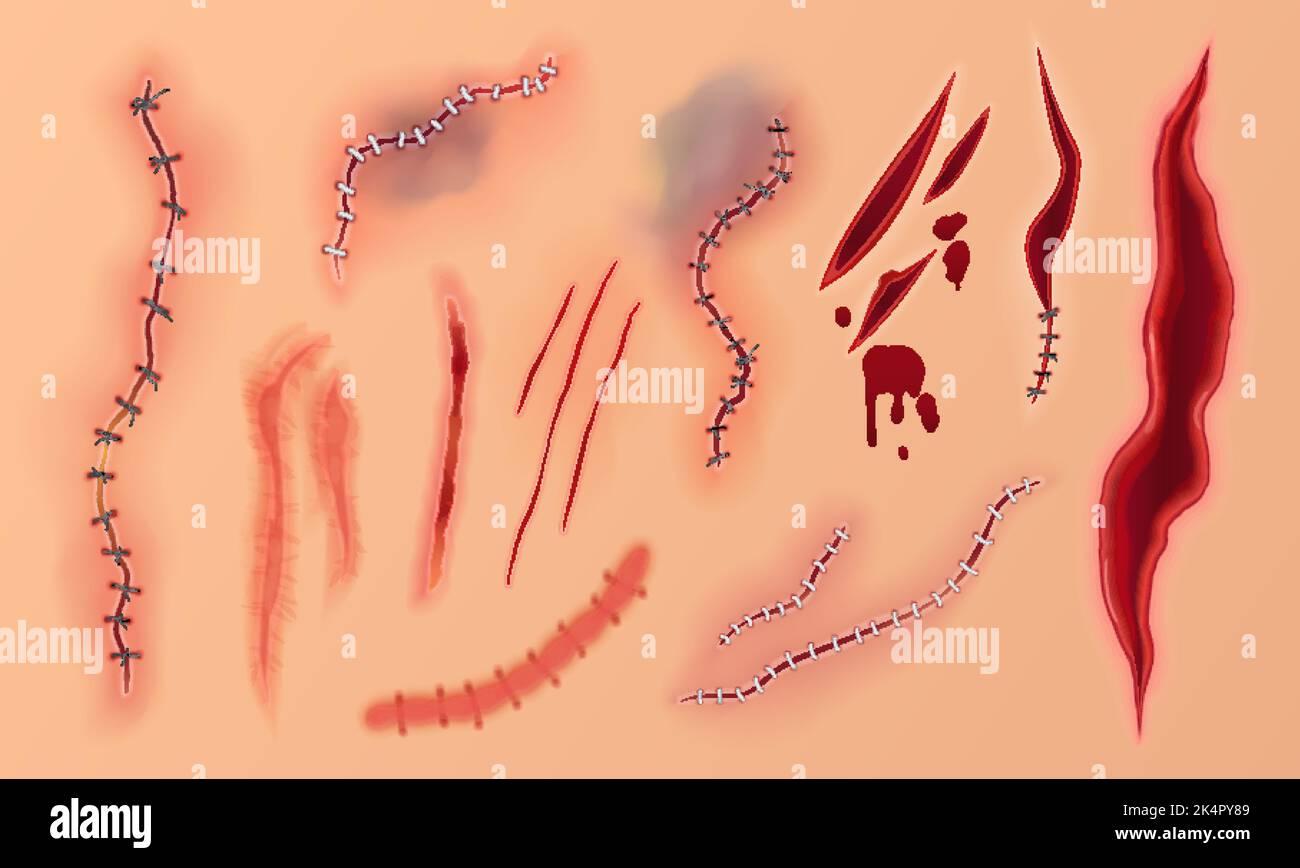 Realistic various surgical stitches, bloody wounds, scars, bruise and slaughter set on the skin ...