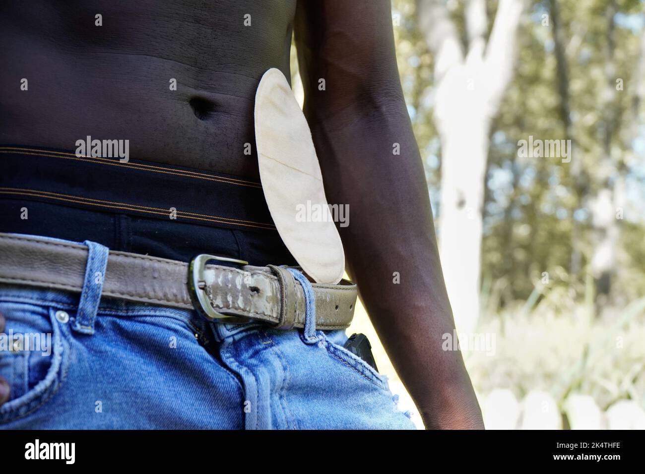 ostomy bag in a black man body Stock Photo - Alamy