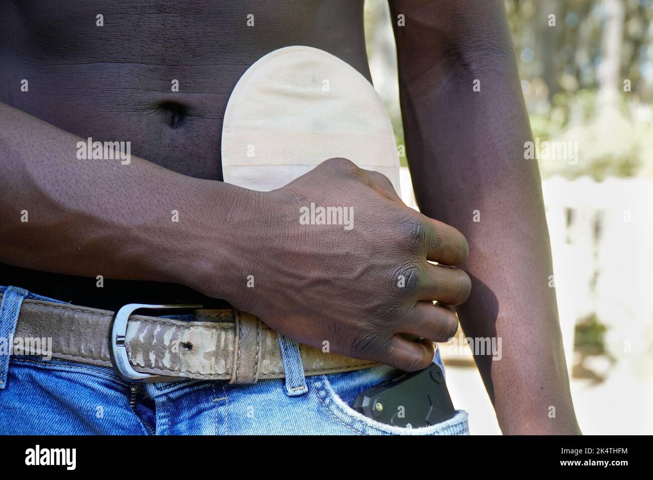 black male body with ostomy bag close-up Stock Photo - Alamy