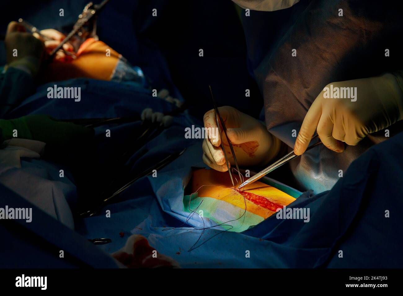 Stitch up hi-res stock photography and images - Alamy