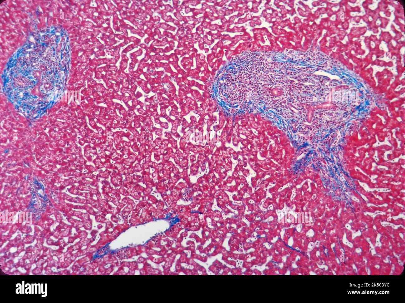 Liver fibrosis, light micrograph Stock Photo - Alamy