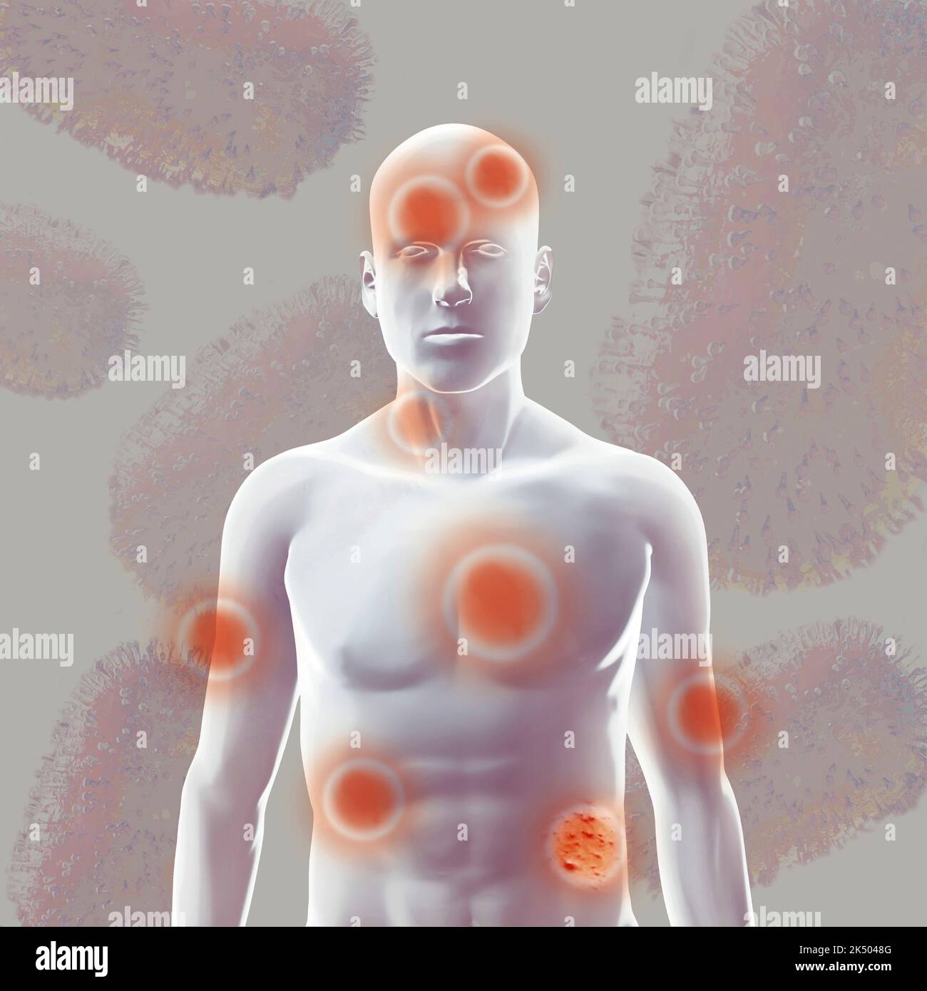 Monkeypox infection, illustration Stock Photo - Alamy