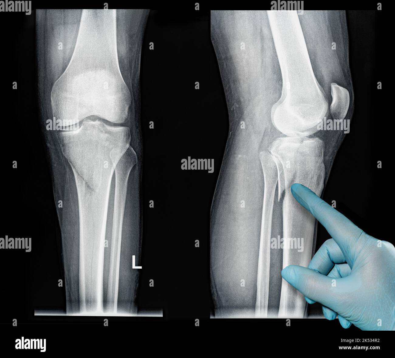 Xray MRI images showing real fracture of broken leg bone under the knee after injury medical ...