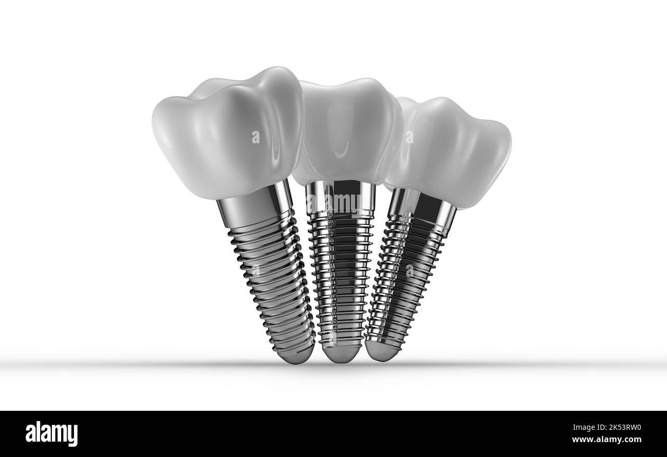 dental implants isolated on a white background. 3d rendering Stock ...