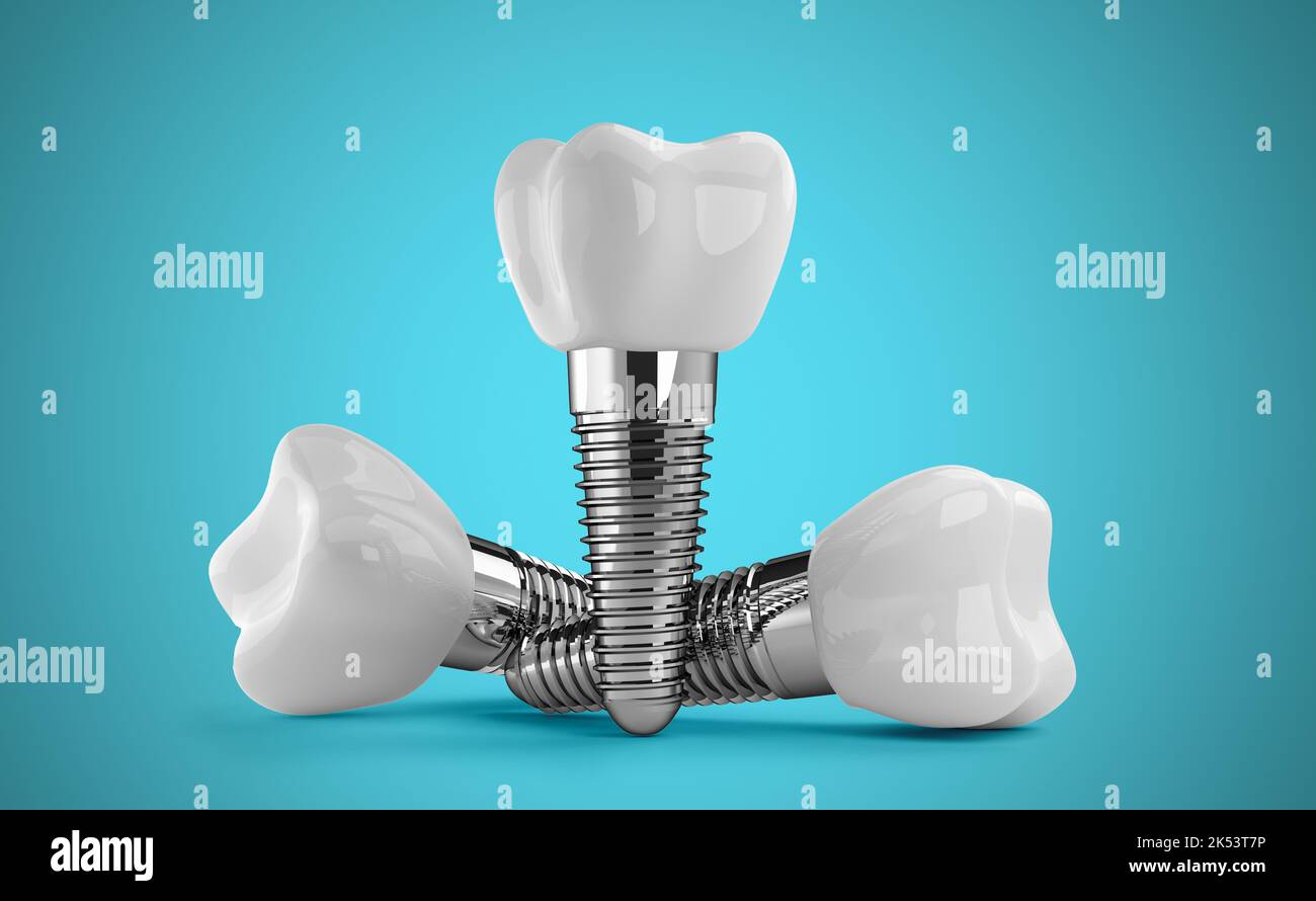 Dental Implant Wallpaper