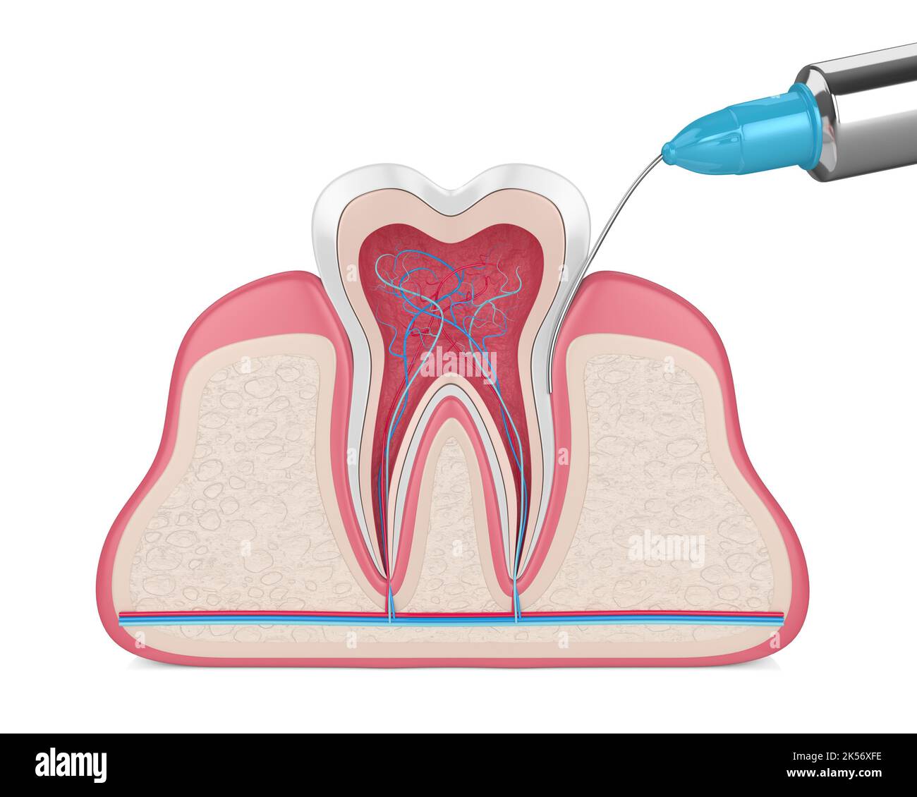 3d render of tooth in gums with intraligamentary anesthesia procedure ...