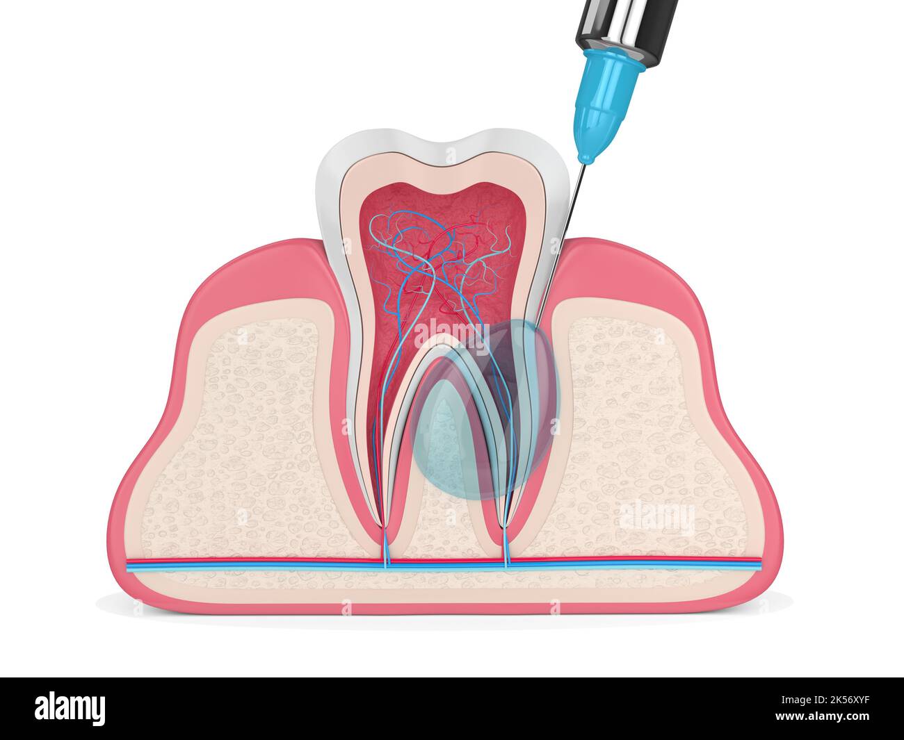 3d render of tooth in gums with intraligamentary anesthesia procedure ...