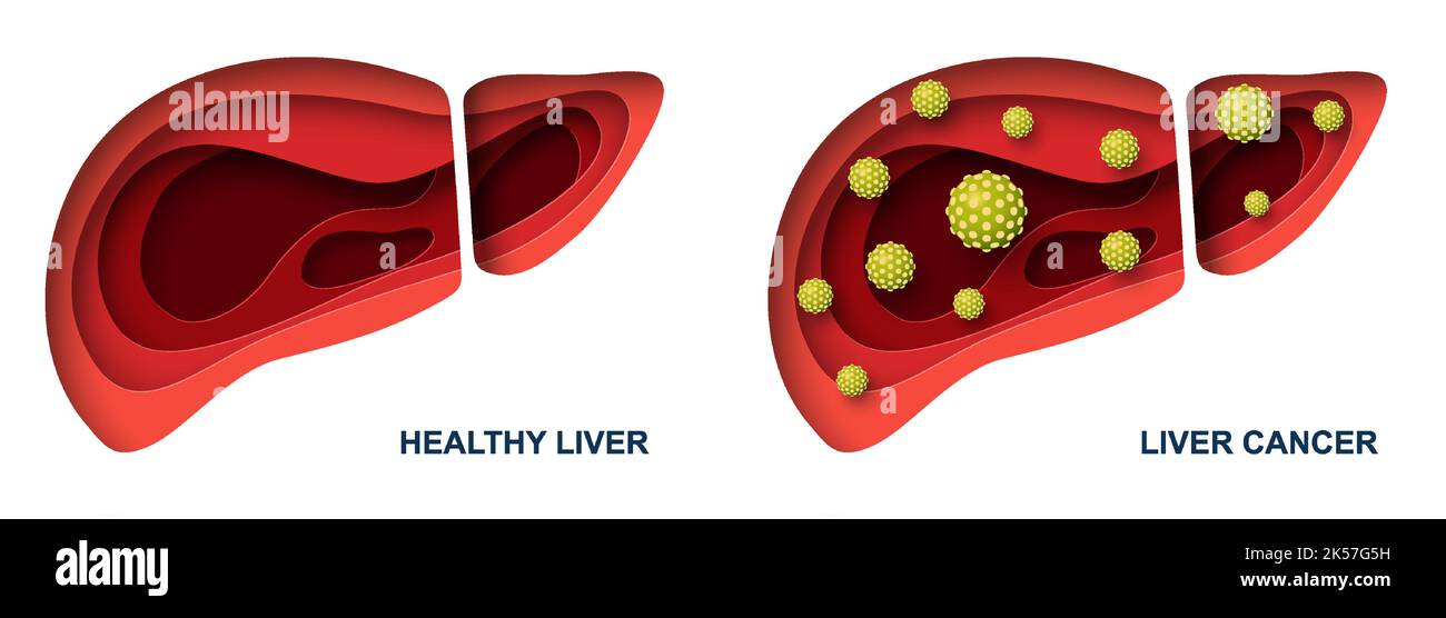 Liver Cancer And Healthy Organ Vector Illustration Stock Vector Image And Art Alamy