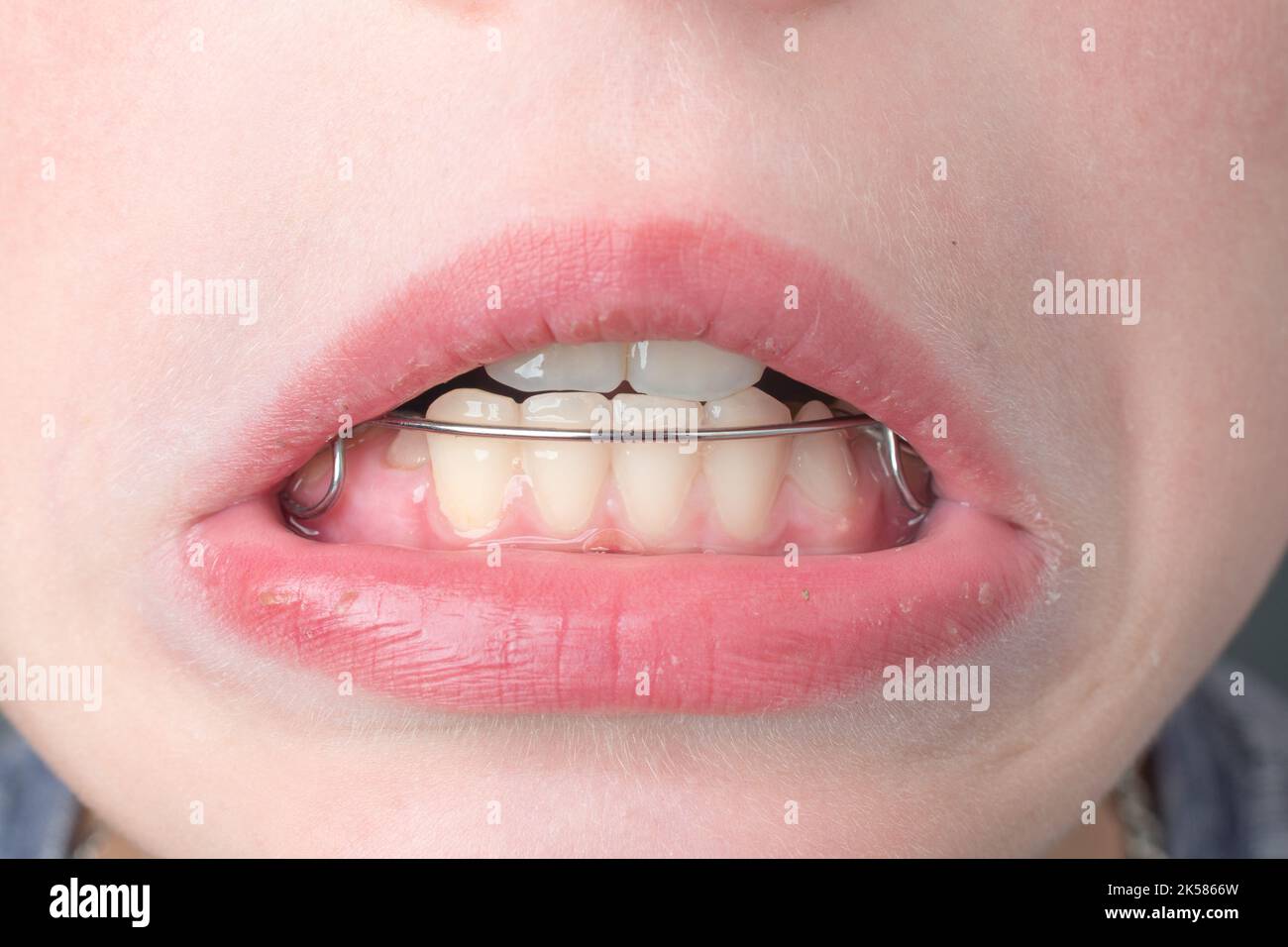 The boy wears a dental plate on the lower jaw, aligning children's ...