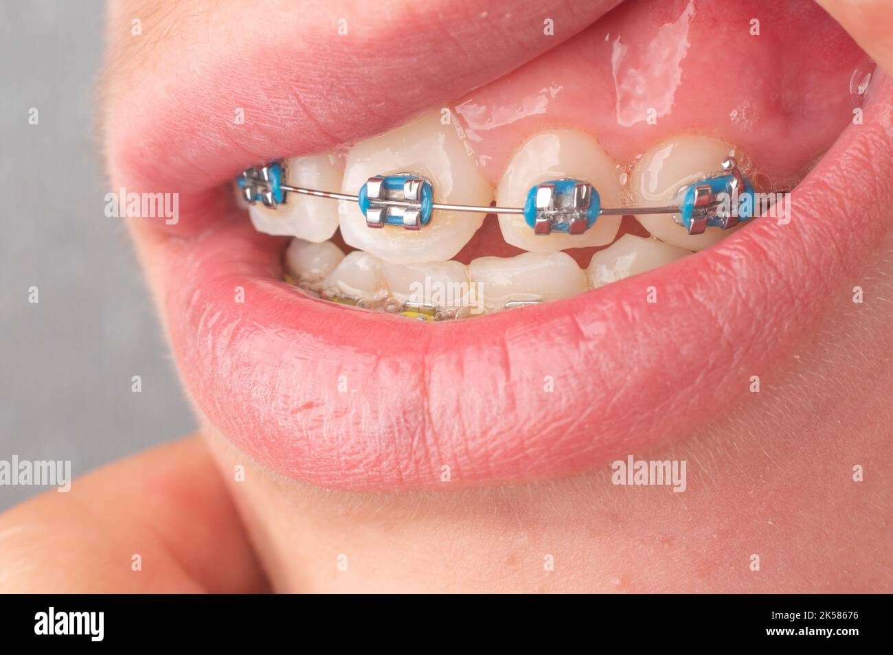 Braces with blue and yellow rubber bands close-up, flag of Ukraine and ...