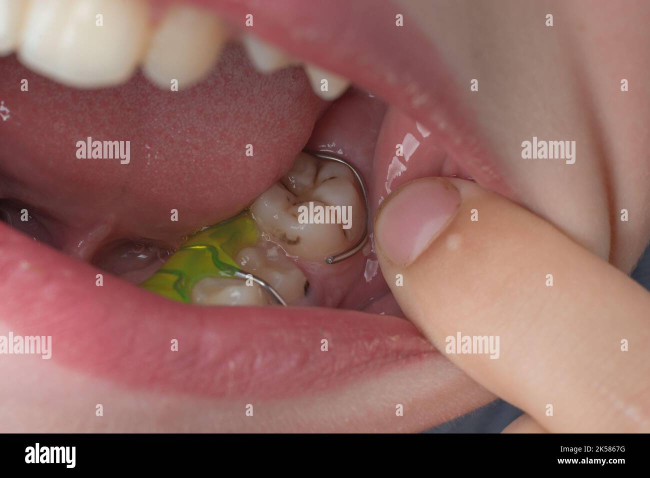 Mandibular plate, boy wearing teeth aligner, teeth and plate in detail ...