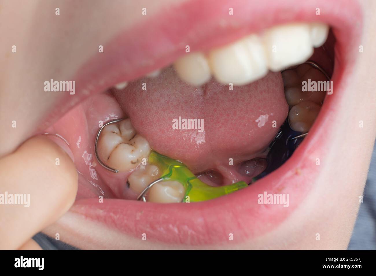 Mandibular plate, boy wearing teeth aligner, teeth and plate in detail ...