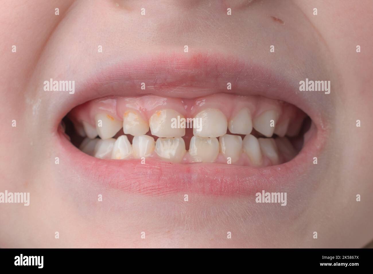 Jaw with child's even teeth close-up, milk and permanent teeth in a ...