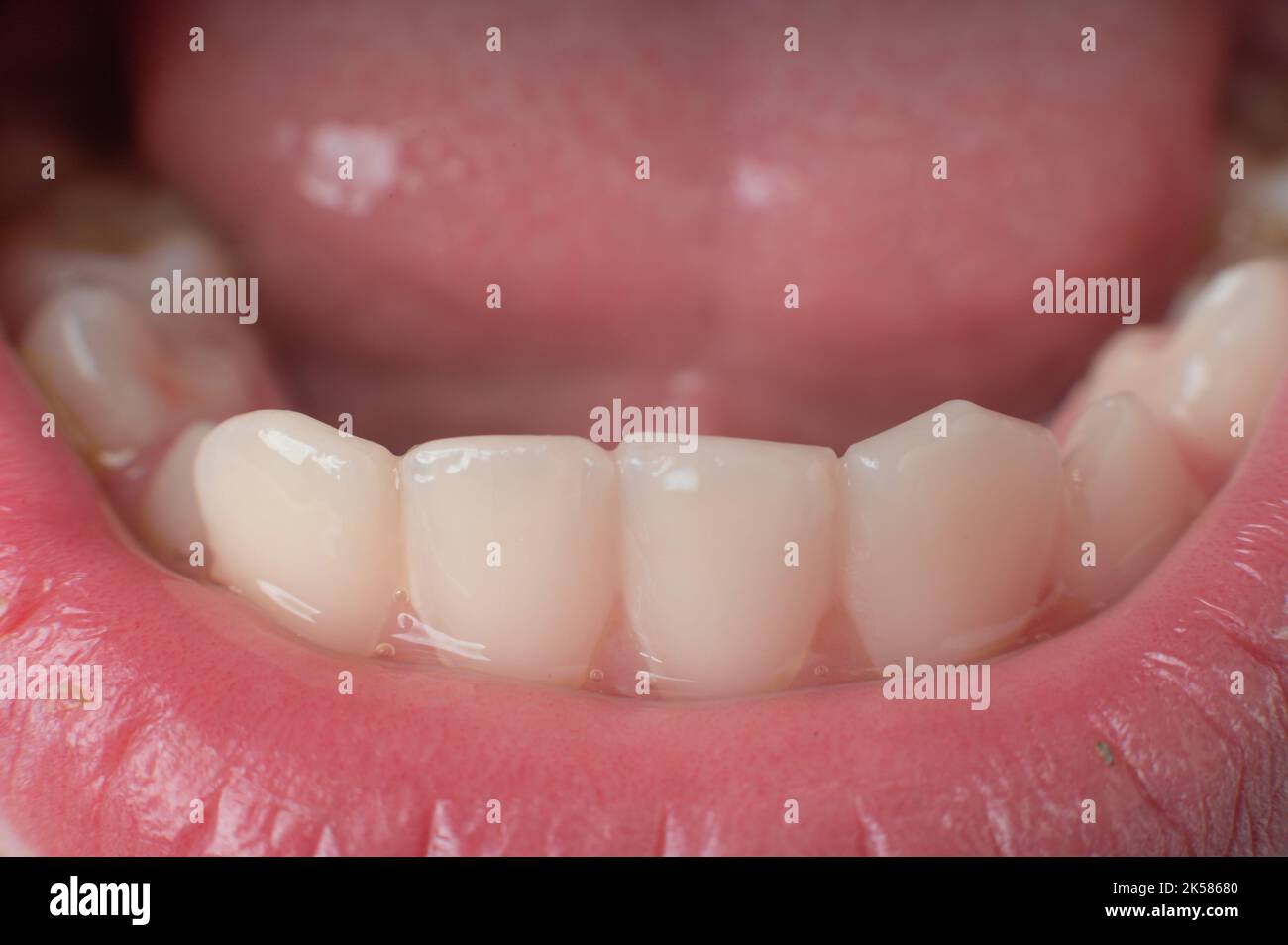 Jaw with children's straight teeth close-up, permanent front teeth of ...