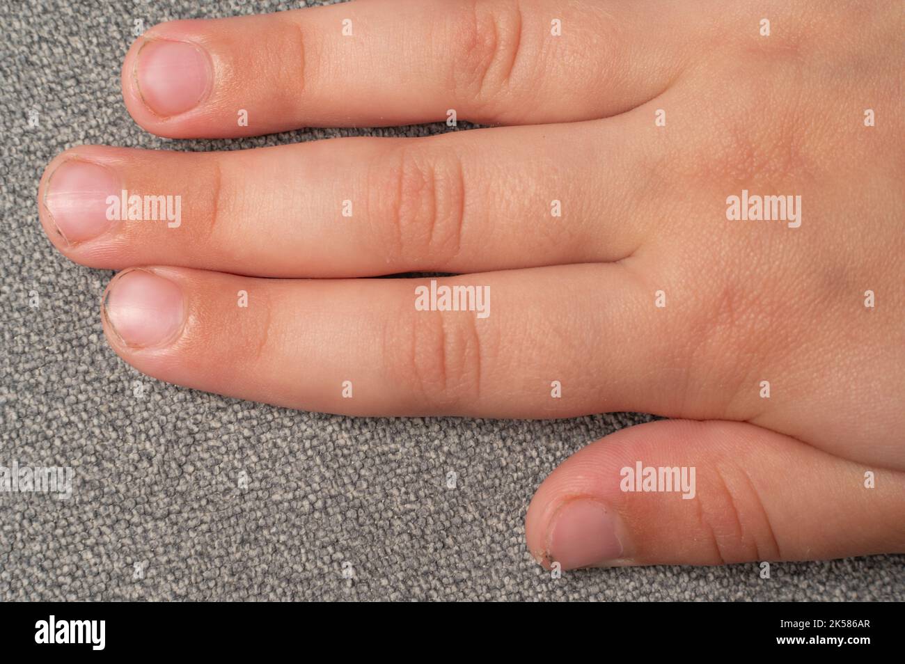 Dirty and sloppily trimmed child's fingernails, fingers and toenails ...
