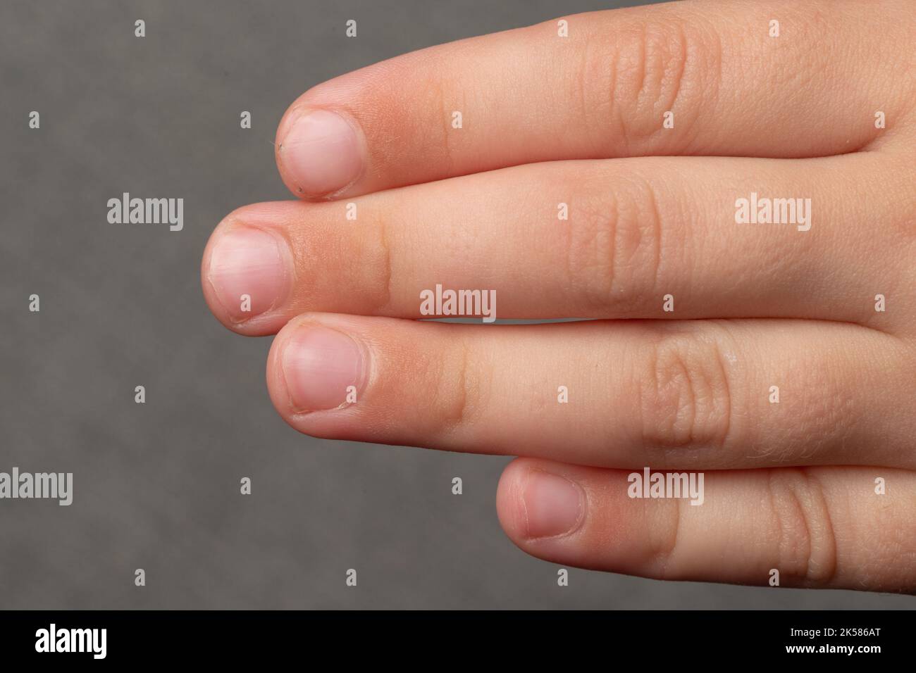 Dirty and sloppily trimmed child's fingernails, fingers and toenails ...