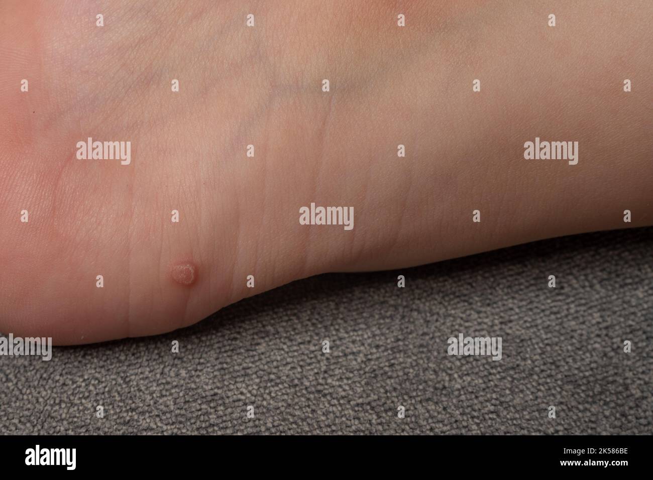 Common wart Verruca vulgaris on the skin of a child, papillomavirus in ...