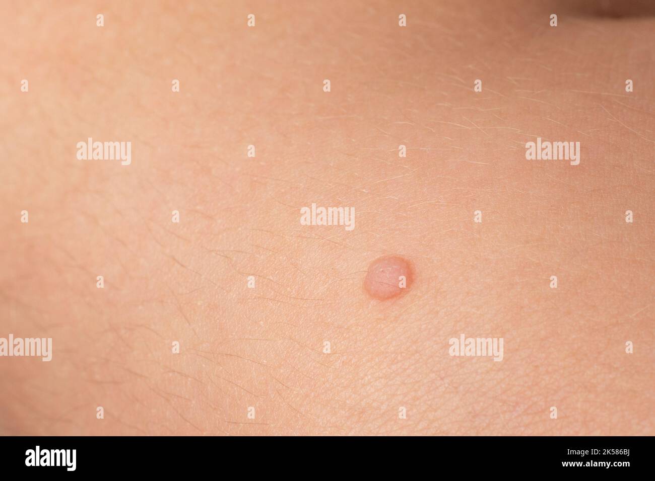 Common wart Verruca vulgaris on the skin of a child, papillomavirus in ...