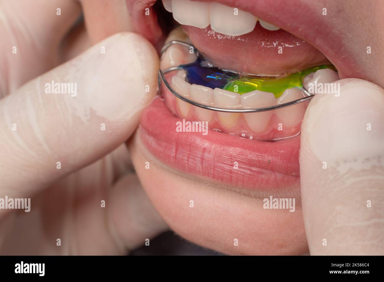 The orthodontist puts a plate on the lower teeth, a visit to the ...