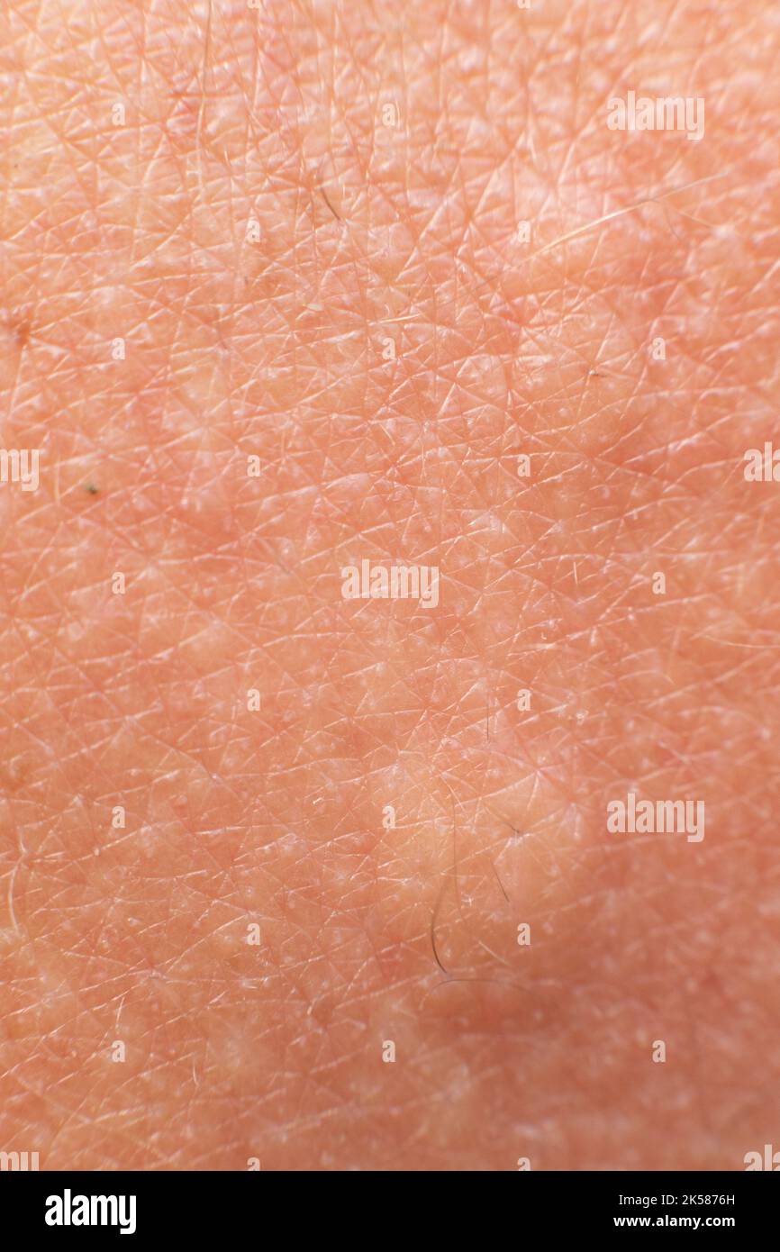 Swollen bee sting site, redness on the skin from a bee sting, close-up ...