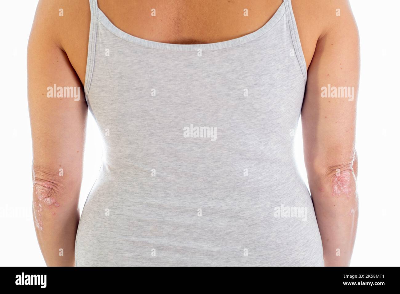 Skin rash woman hi-res stock photography and images - Alamy
