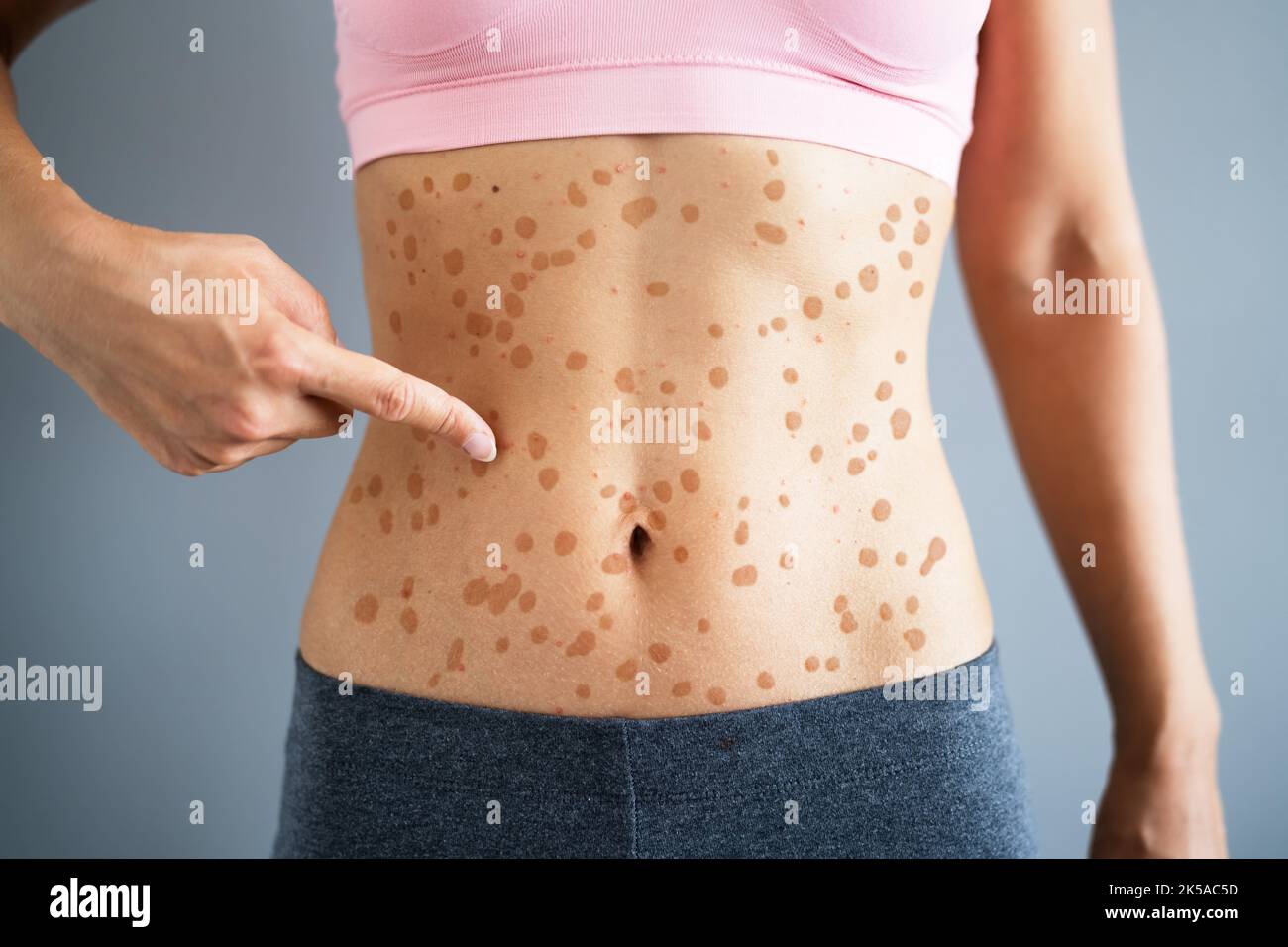 Woman Body Skin Rash With Red Allergy Eruption Stock Photo - Alamy